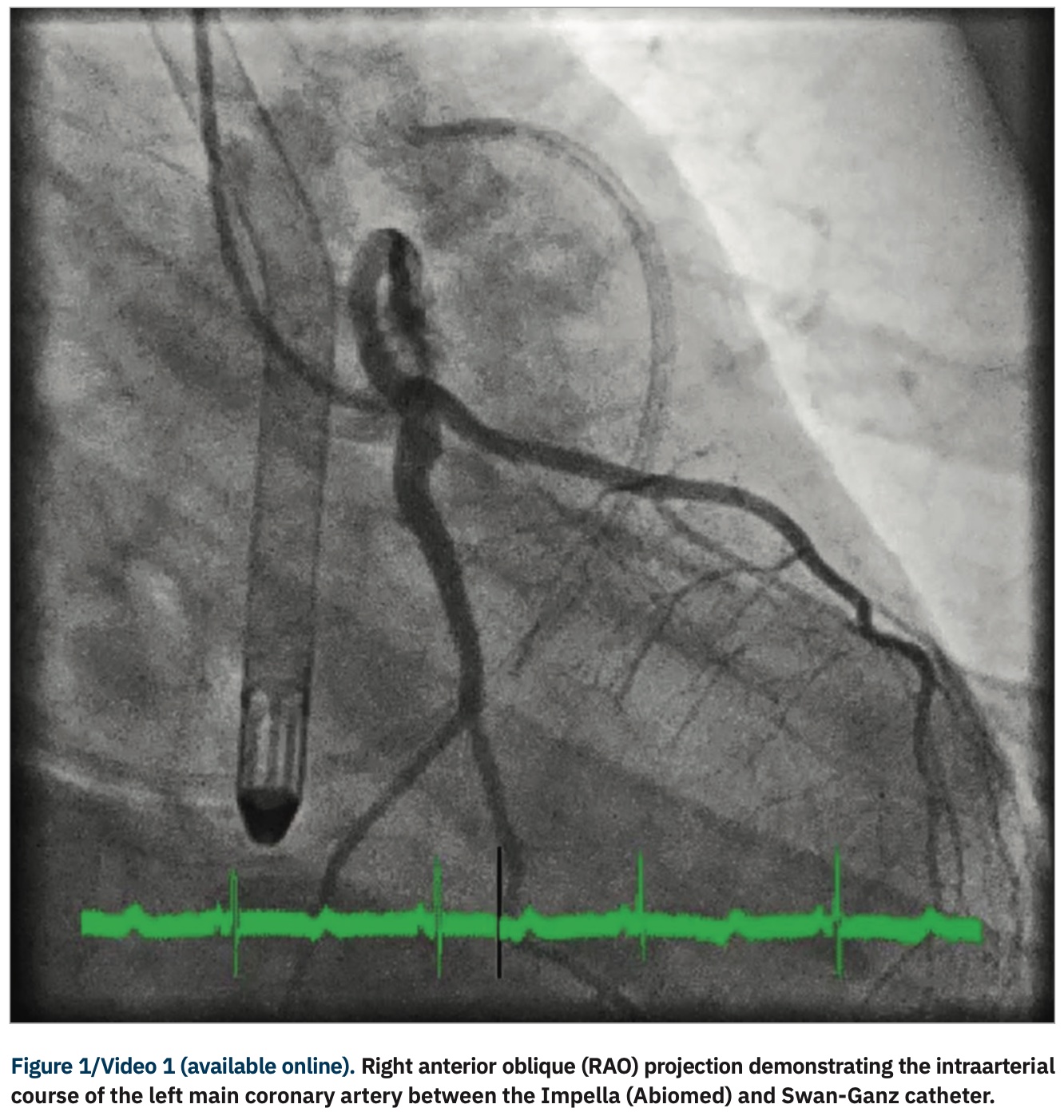 Intramural Course of the Left Main Coronary Artery