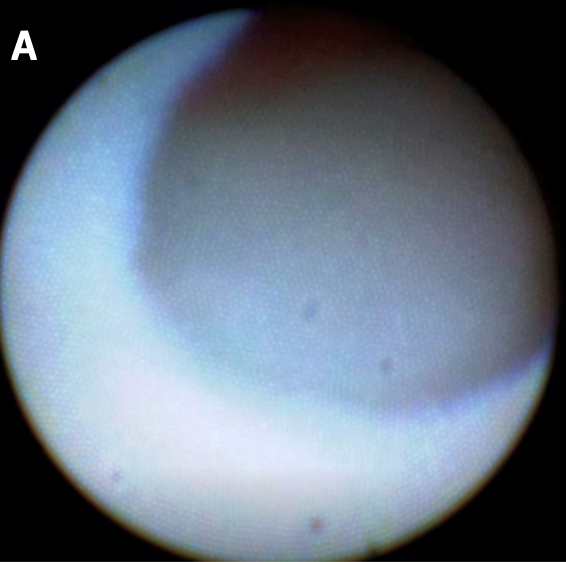 Endothelialization of Amplatzer PFO Occluder Device