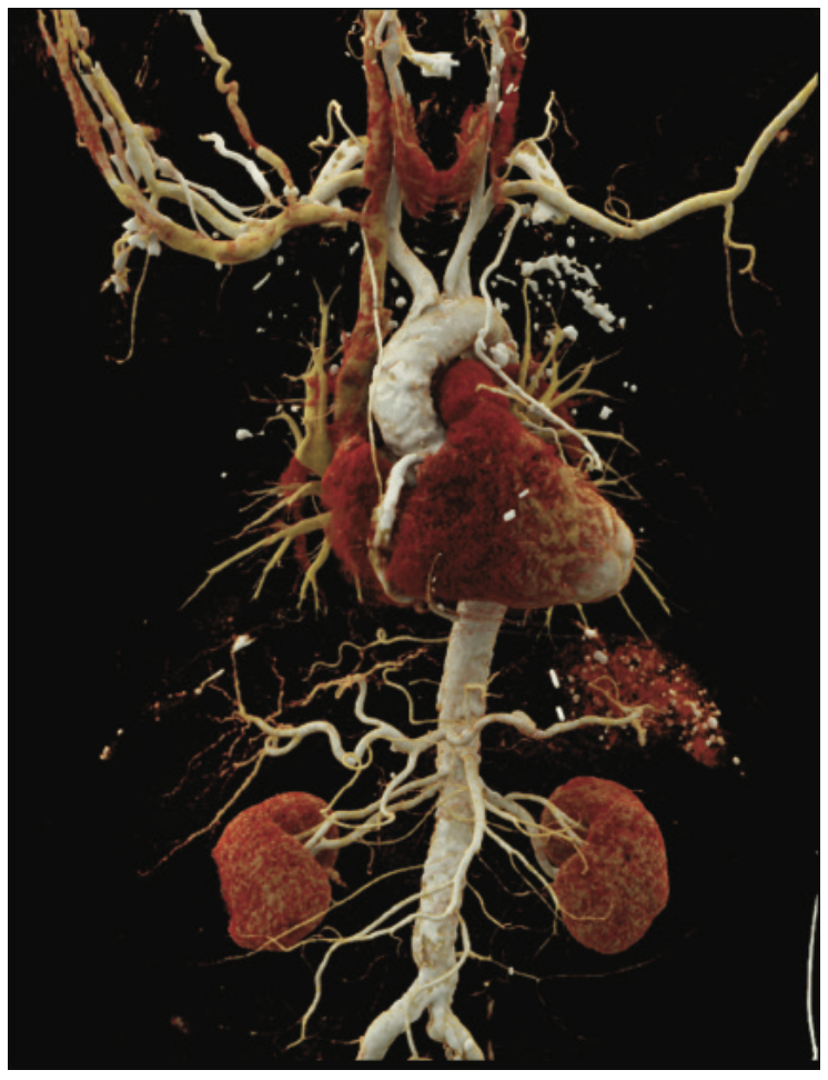 Dual Source CT Enables High-Quality Cardiac Imaging Pre- and Post-TAVR ...