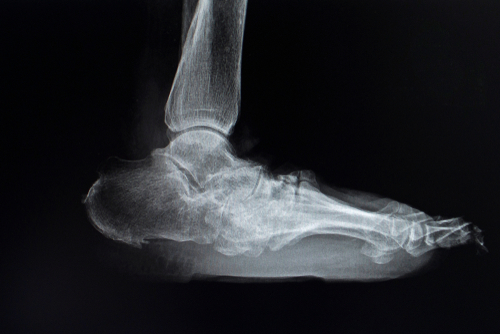 Femoral Head Allograft Improved Pain and Function in 10-Year Follow-up ...