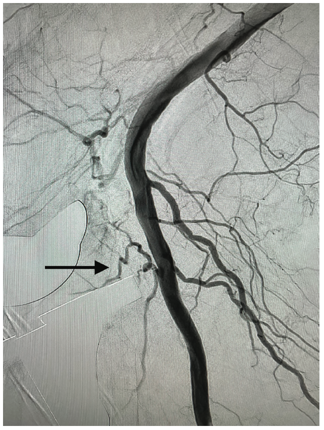 Novel Transpedal Percutaneous Treatment of Delayed Recurrent ...
