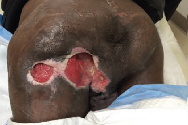 Surgical Therapy for Complex Pelvic Pressure Injuries: A Review of ...