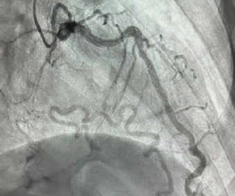 Rare Variant of the Obtuse Marginal Artery Originating From the Left ...