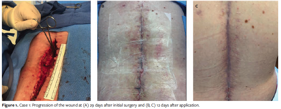 A Unique Approach to Neurosurgical Wound Closure With Porcine Urinary ...