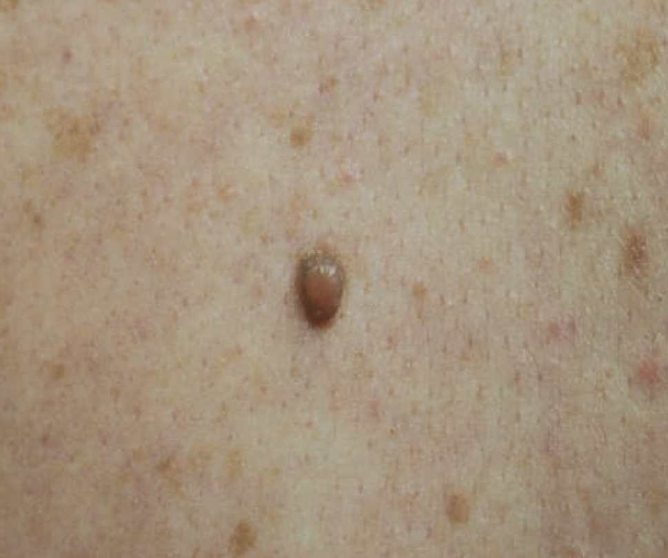 What Is This Red-Brown Lesion on the Patient’s Back?