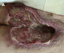 Urinary Bladder Matrix Devices Support Closure in Complex Sacral Wounds