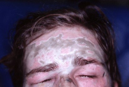 Alkali Burns of the Skin