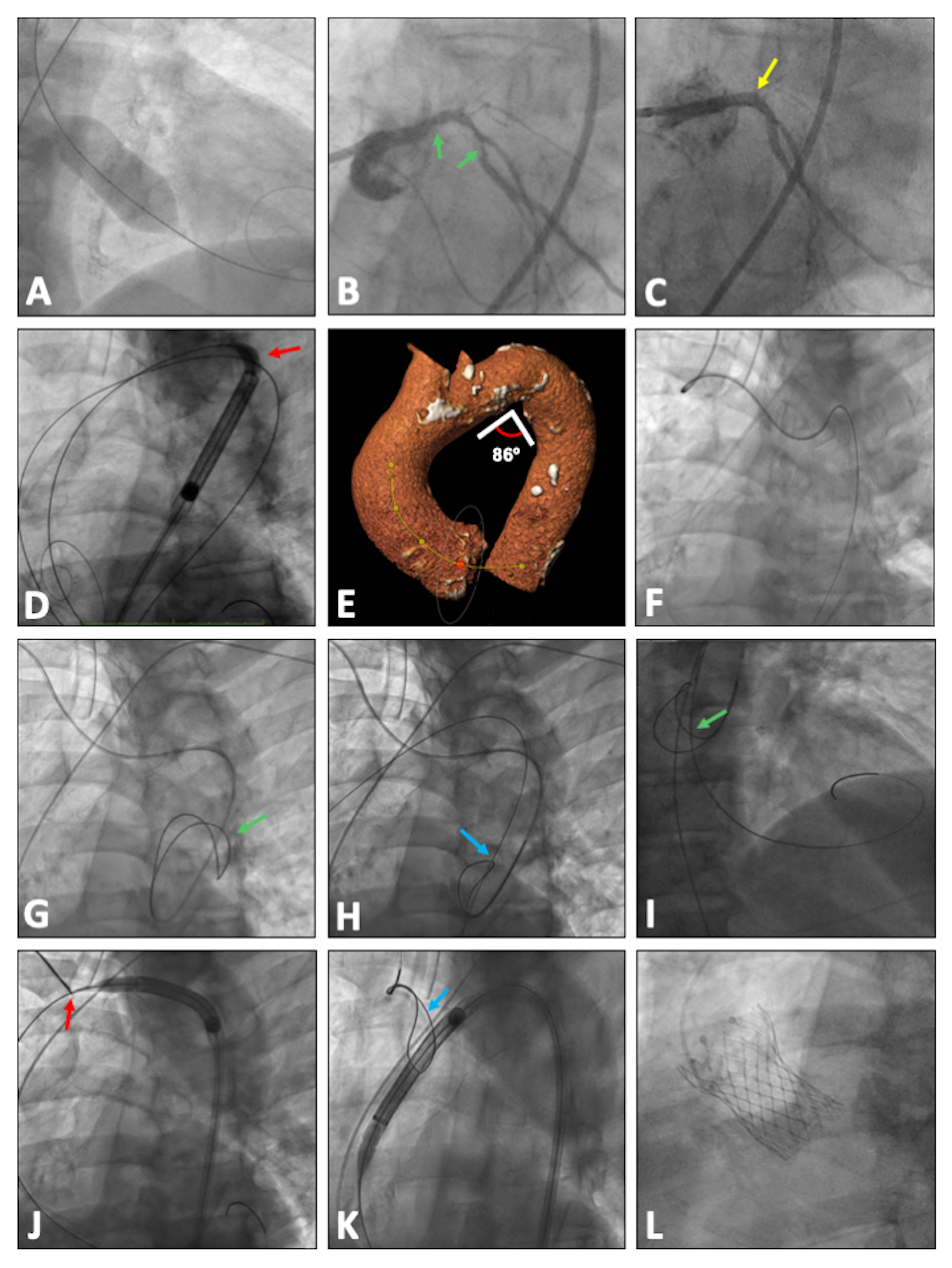 Placement of a Self-Expanding Transcatheter Aortic Valve Prosthesis in ...