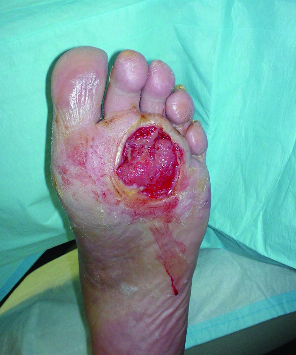 Managing Wound Pain: International Perspectives on Assessments ...