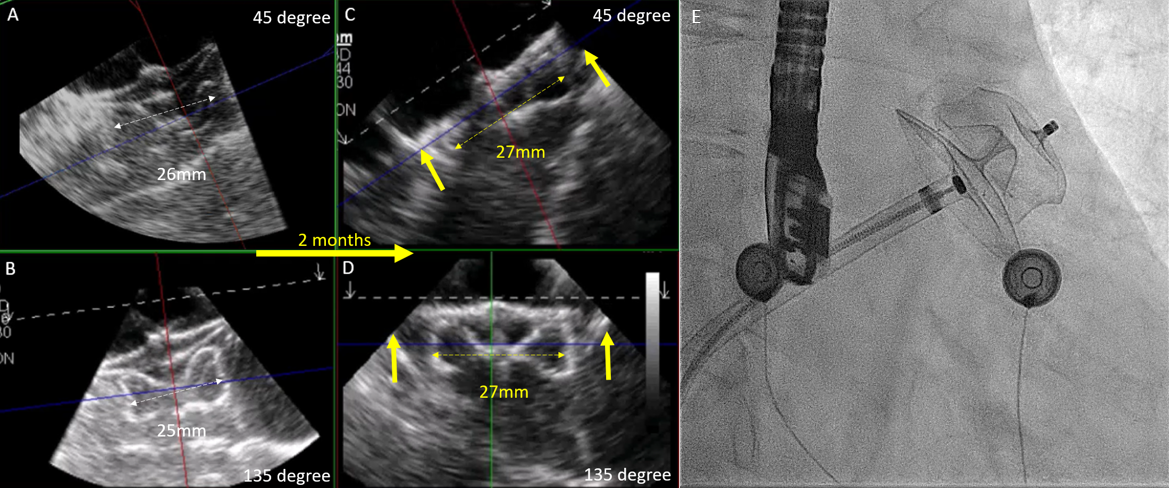 Early LAAO Device Migration After Combined Atrial Fibrillation Ablation ...