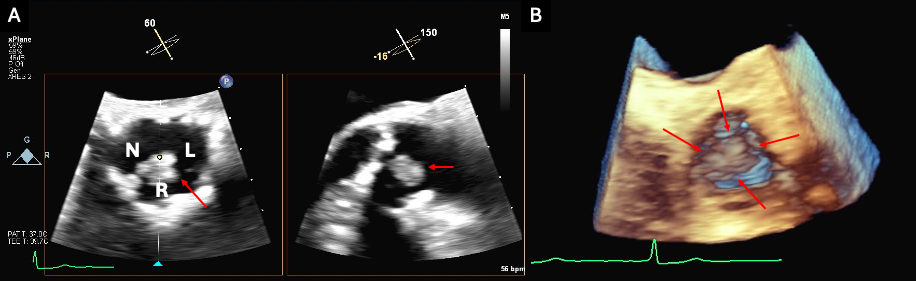 Right Coronary Artery Obstruction Following Transcatheter Aortic Valve ...