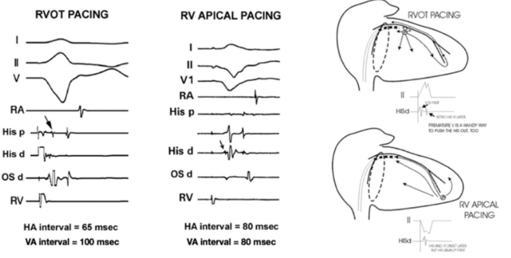 Essential Elements of an Electrophysiology Study: Decremental ...
