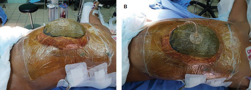 The Utility of Negative Pressure Wound Therapy in the Management of ...