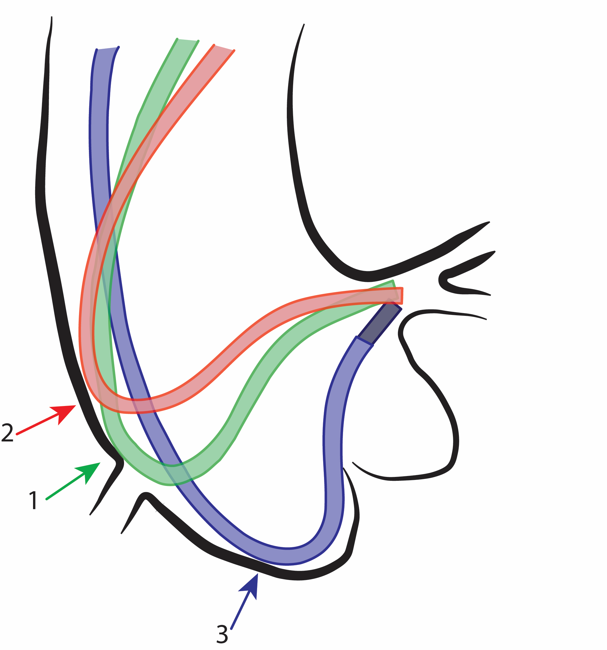 Technical Success and Long-Term Experience of a Novel Radial Guide ...