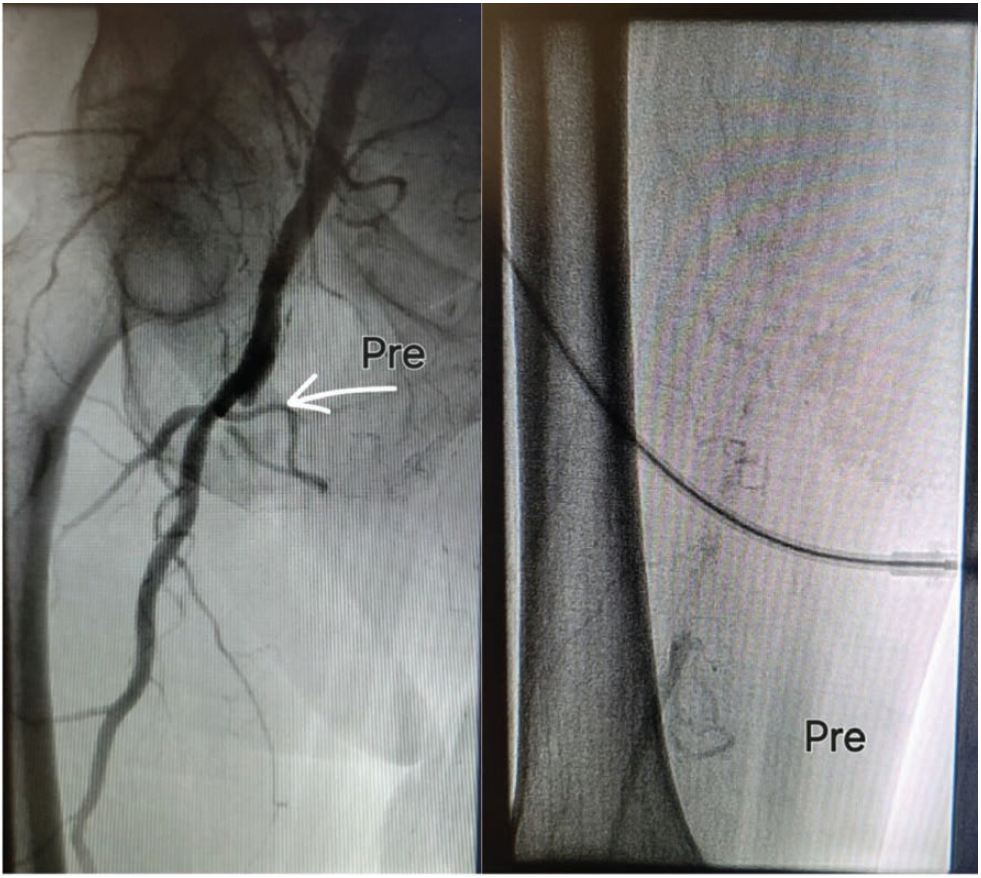 Treating a CTO of the SFA Using Auryon Laser Atherectomy in a CLTI Patient