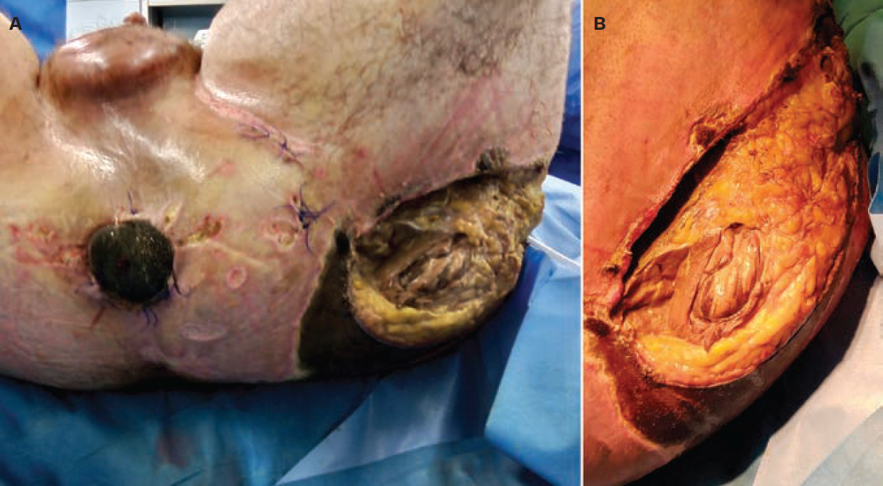 Use of Negative Pressure Wound Therapy in the Management of Extreme ...