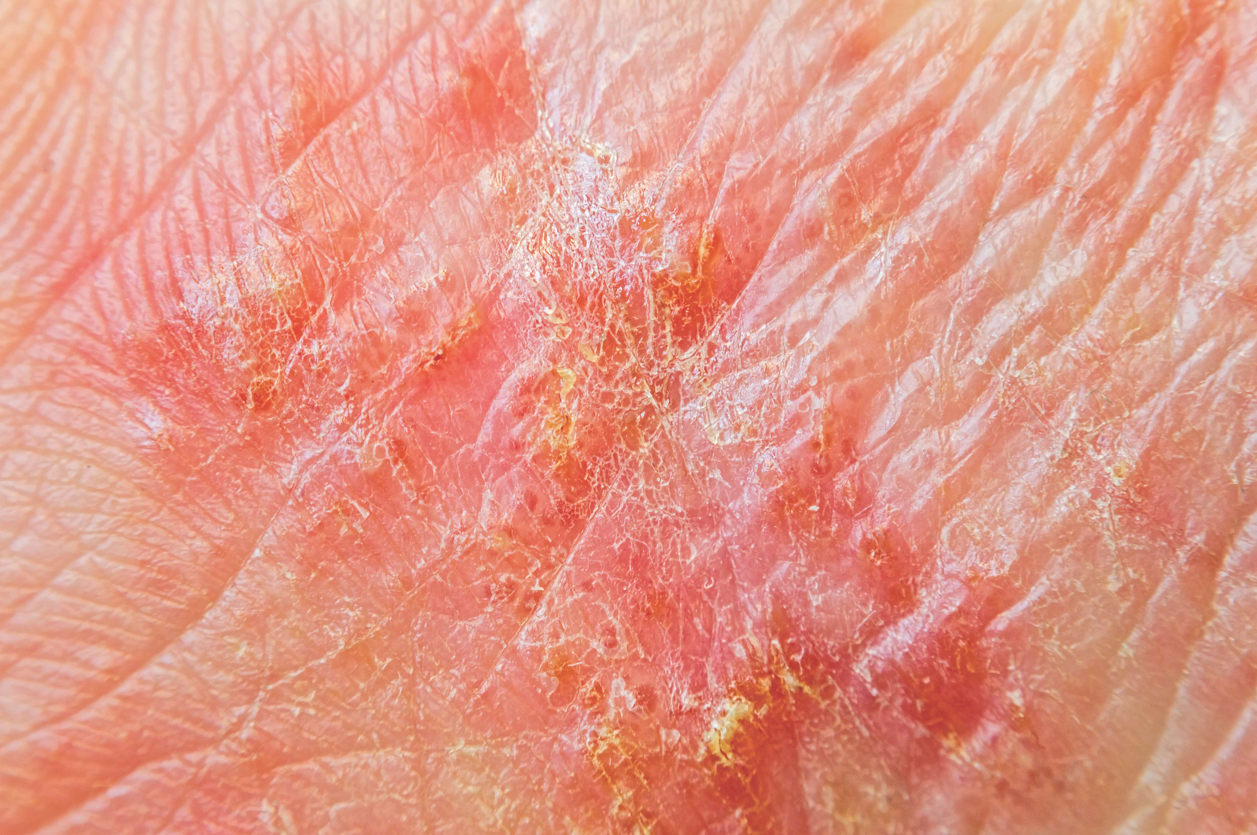 Understanding Type 2 Inflammation: Pathways and Treatment Options