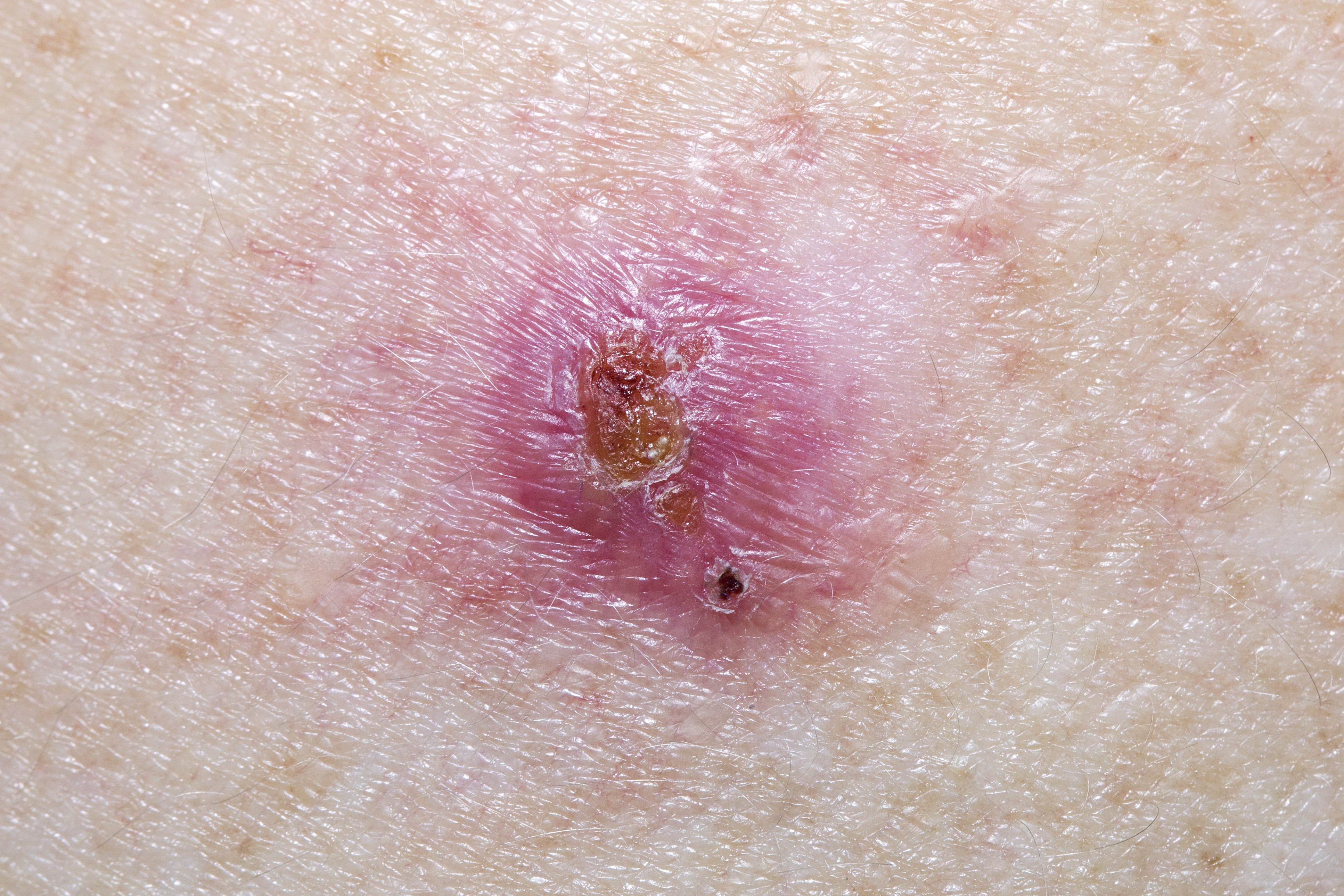 Phase 3 Trial Demonstrates Significant Benefits of Libtayo in High-Risk ...