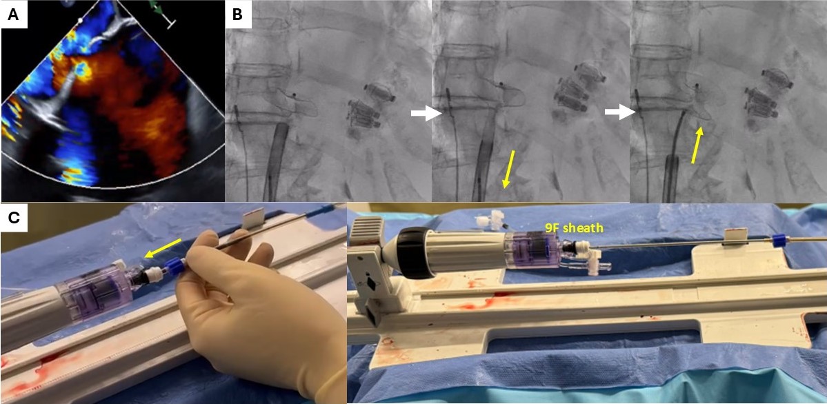 Iatrogenic Atrial Septal Defect Closure With PASCAL Guide System Post ...