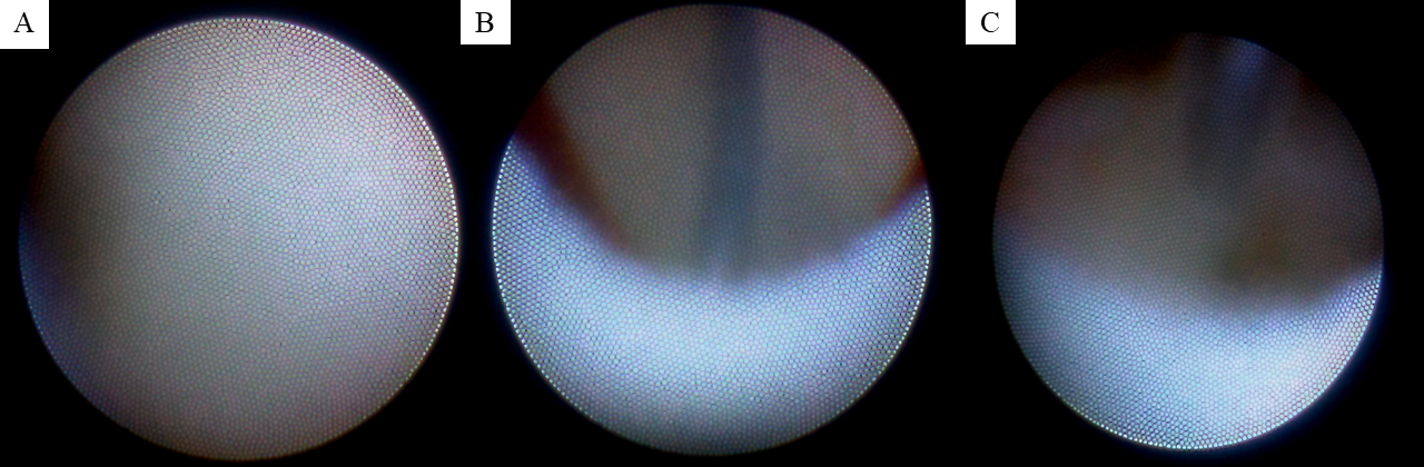 Excellent Endothelialization of the GORE CARDIOFORM Septal Occluder ...