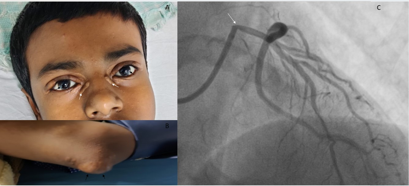 Familial Hypercholesteremia With Left Main Ostial Disease in a Young Male