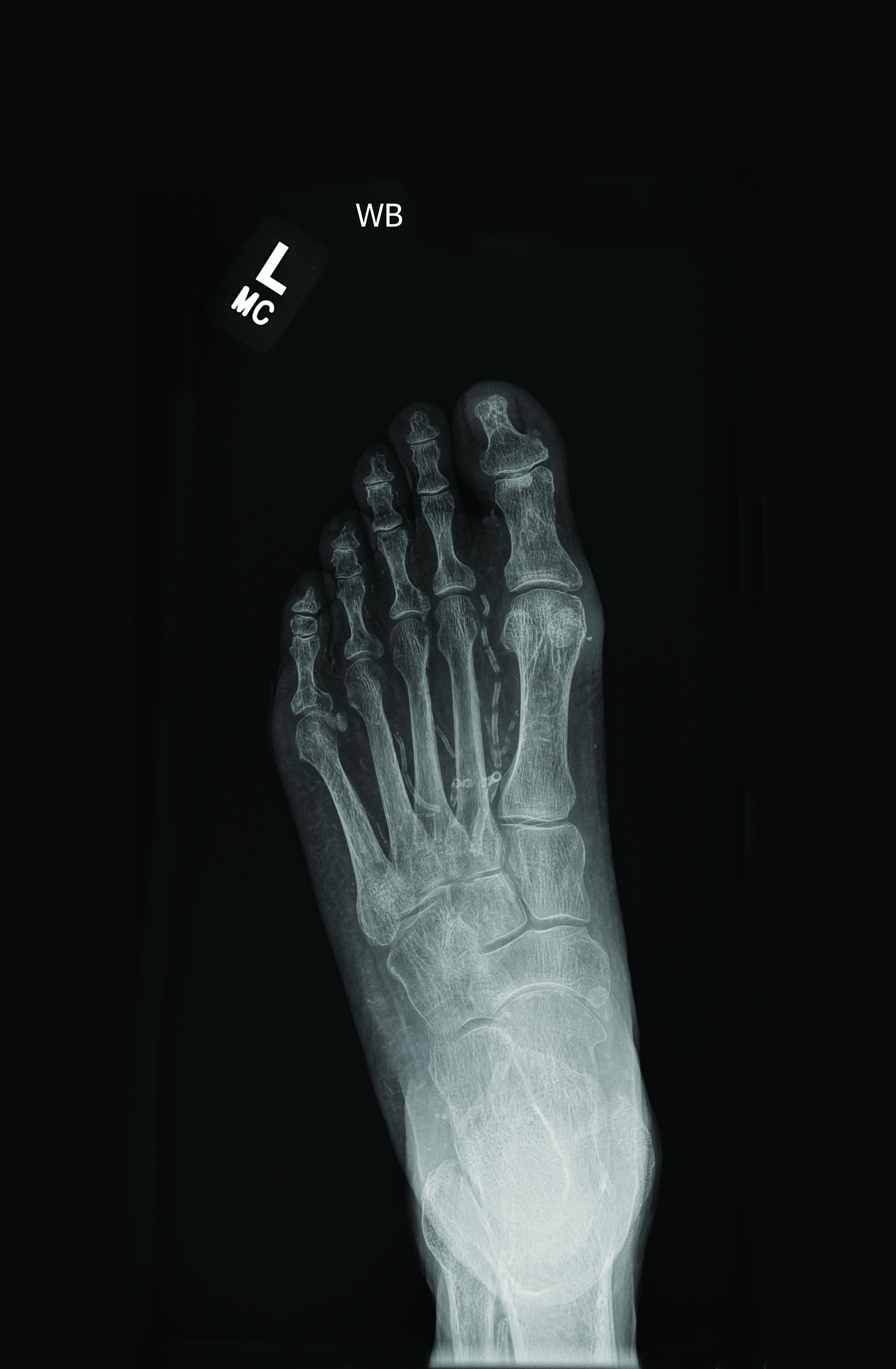 Medial Arterial Calcification: An Underappreciated Factor in Diabetic ...