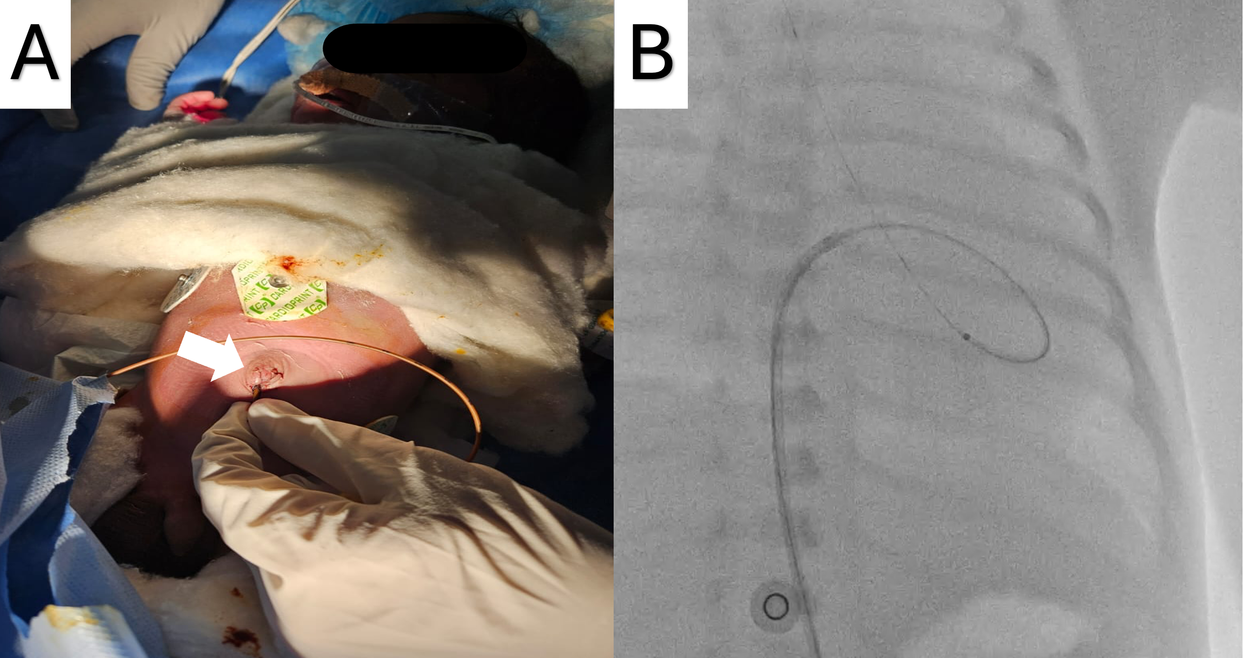 Balloon Aortic Valvuloplasty via Umbilical Venous Access in a Neonate ...