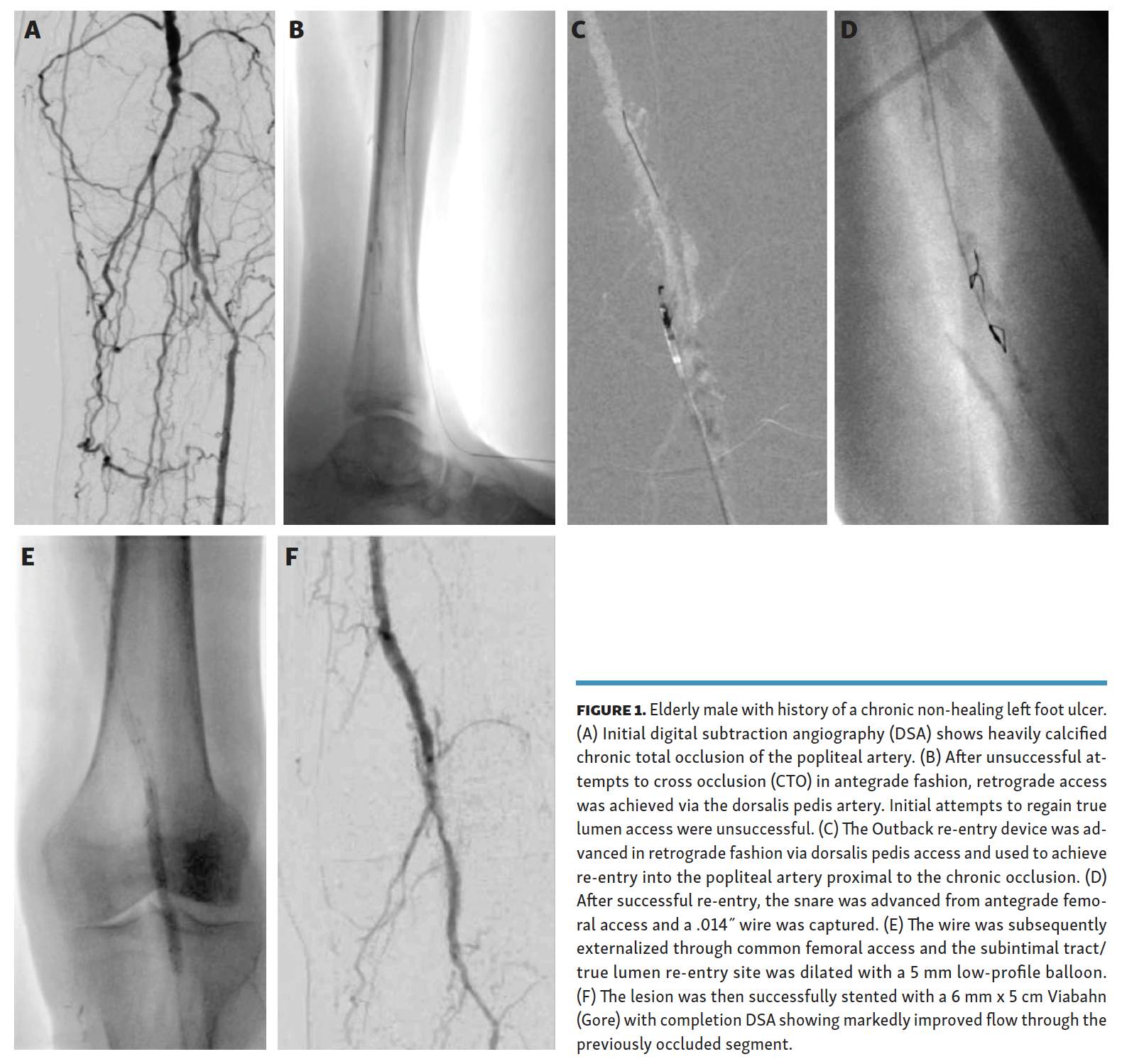 Antegrade and Retrograde Crossing of Chronic Total Occlusions|JCLI