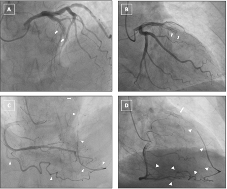 Collateral Clarity: Balloon Occlusion of an Epicardial Right Coronary ...
