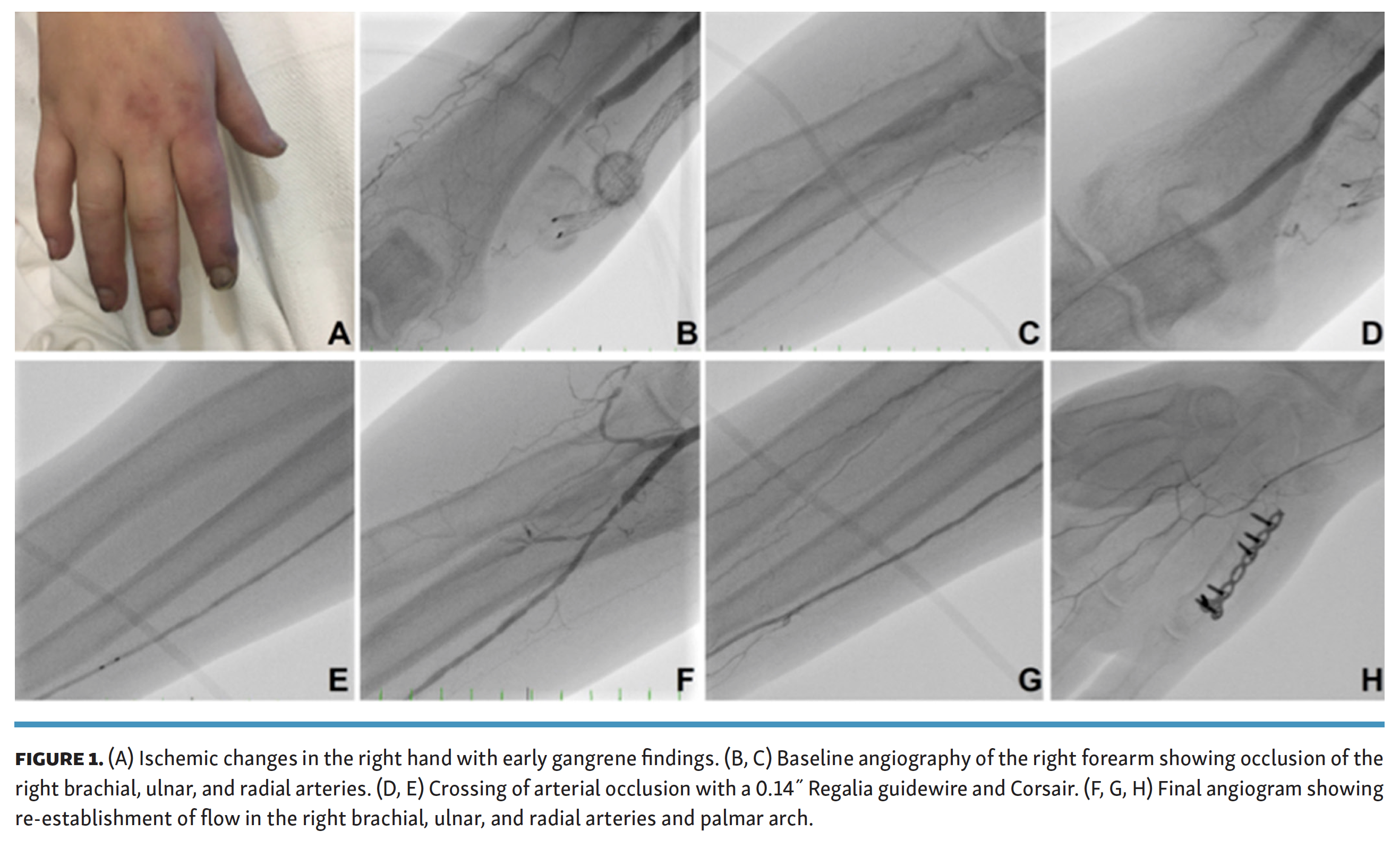 Successful Treatment of Critical Hand Ischemia With Orbital Atherectomy ...