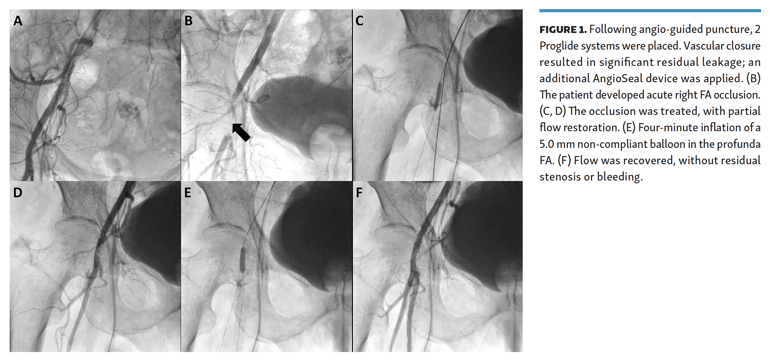 Acute Occlusion of 14 Fr Femoral Access Site After Suture/Collagen ...