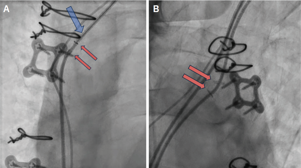 Atrial Lead Failure Secondary to Hemostatic Surgical Clip Entrapment