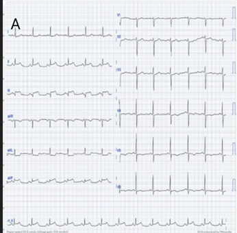 Diagnosing Acute Chest Pain — From ECG to Imaging