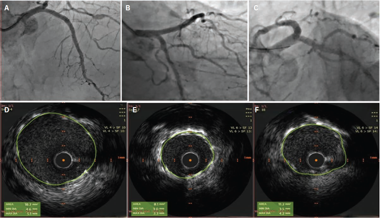 PCI of Medina 0.0.1 Bifurcation Lesion: Orbiting Around the Ostium