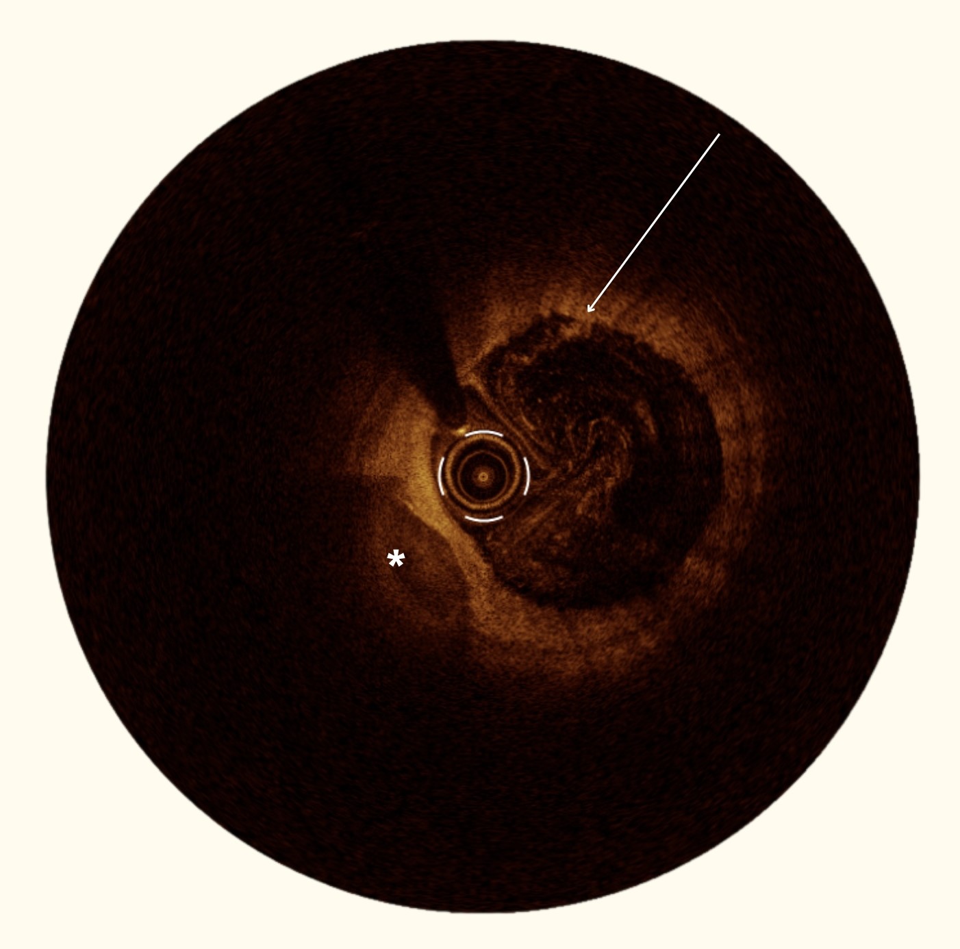 Coronary Artery Ectasia and Acute Coronary Syndrome: Insights From ...