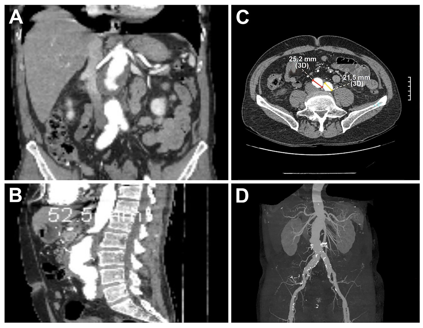 Endovascular Repair of a Complex Thoracoabdominal Aneurysm Using ...