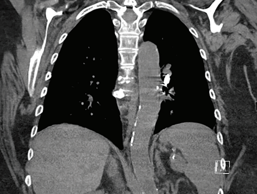 Femoral Access Retrieval of Dislodged Leadless Pacemaker From the ...