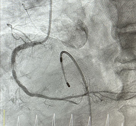 Ruptured Intra-Aortic Balloon Pump Balloon Entrapment Successfully ...