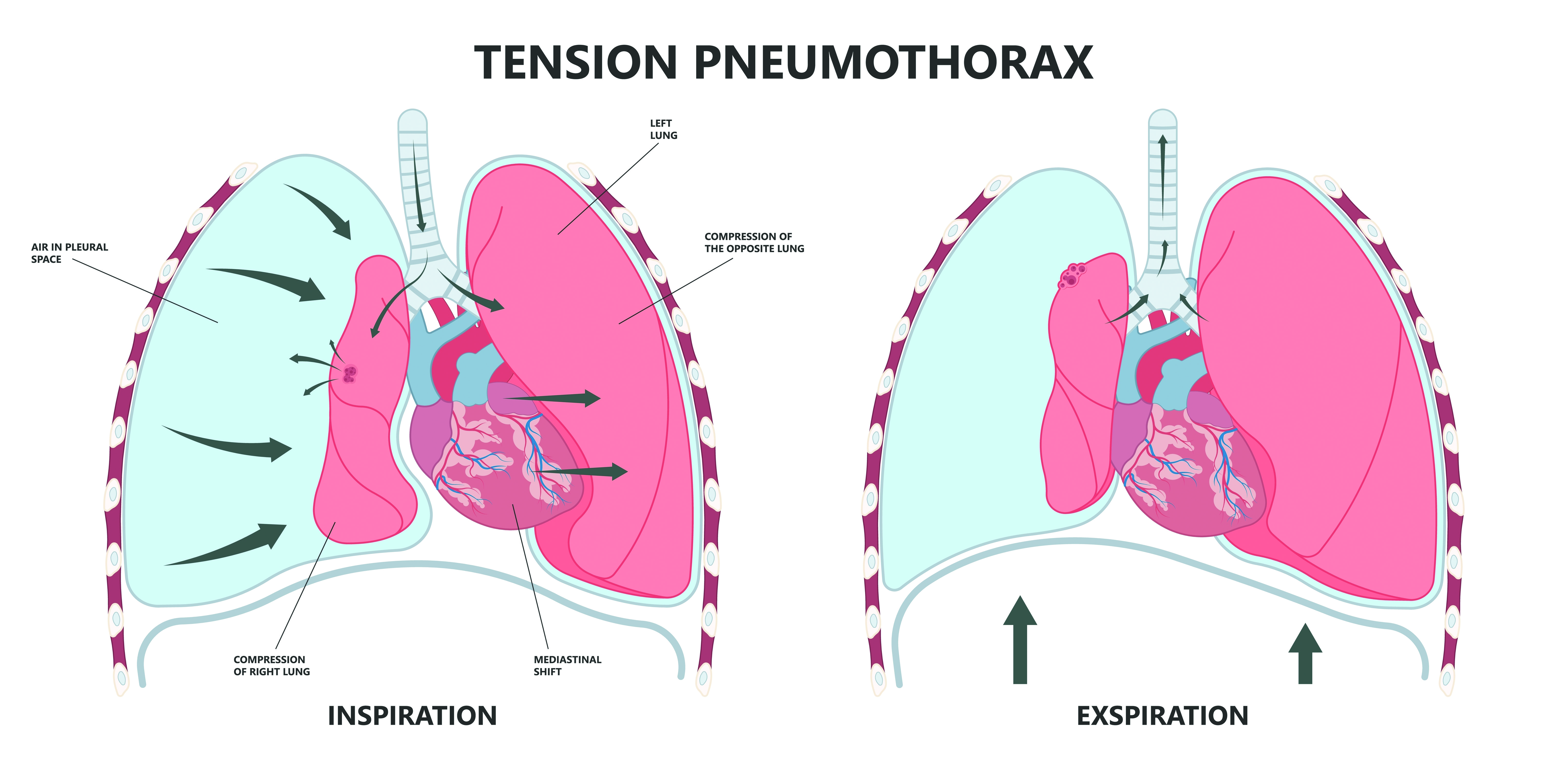 Venting Tensions with Needle Thoracostomies