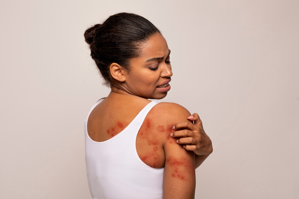 Upadacitinib Achieves Consistent Skin Clearance Across Body Regions in ...