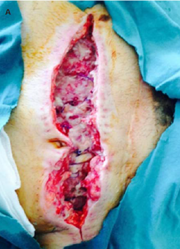 The Effect of Negative Pressure Wound Therapy on Abdominal Deep ...