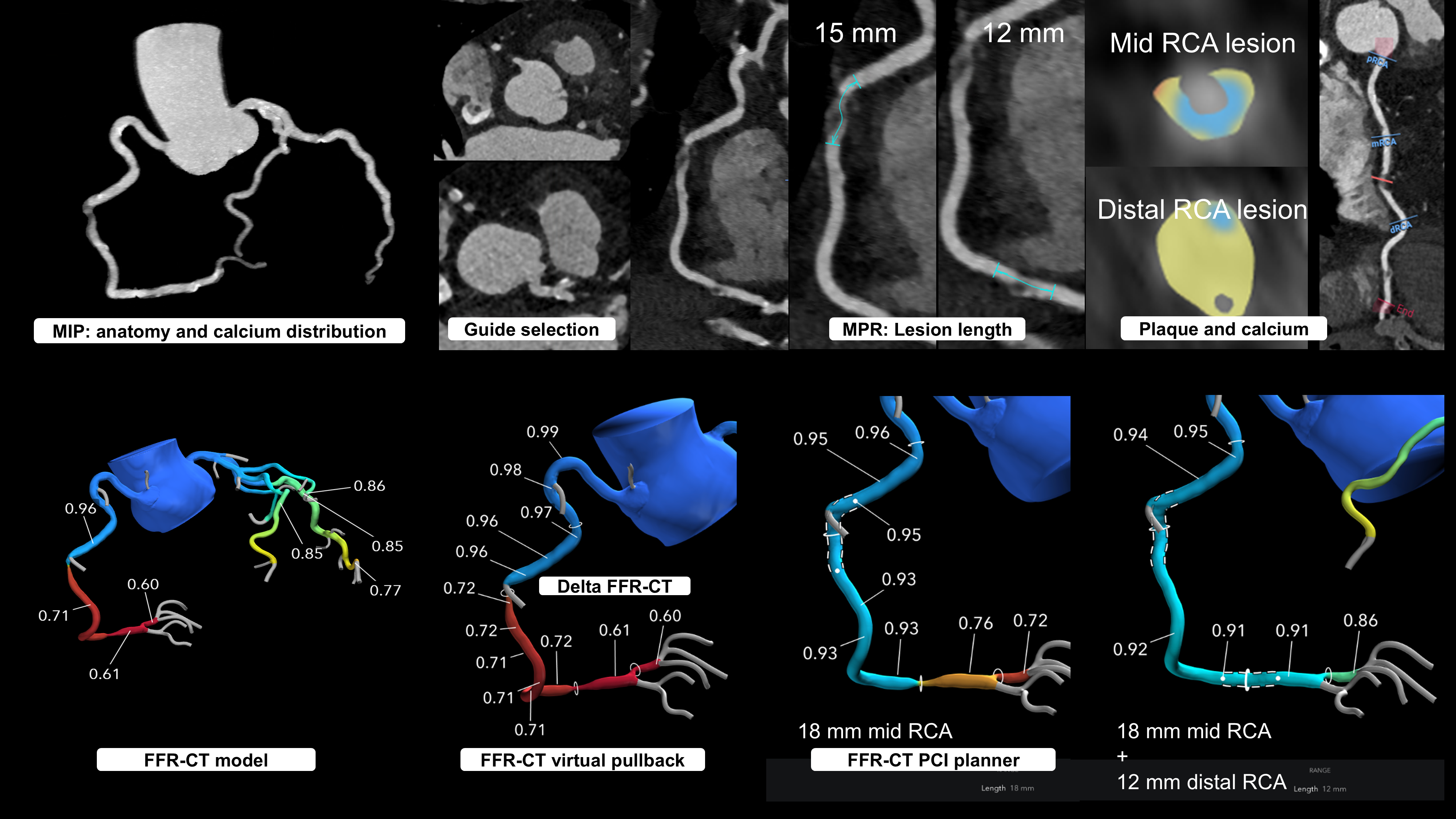 Coronary Computed Tomography Angiography to Guide Percutaneous Coronary ...
