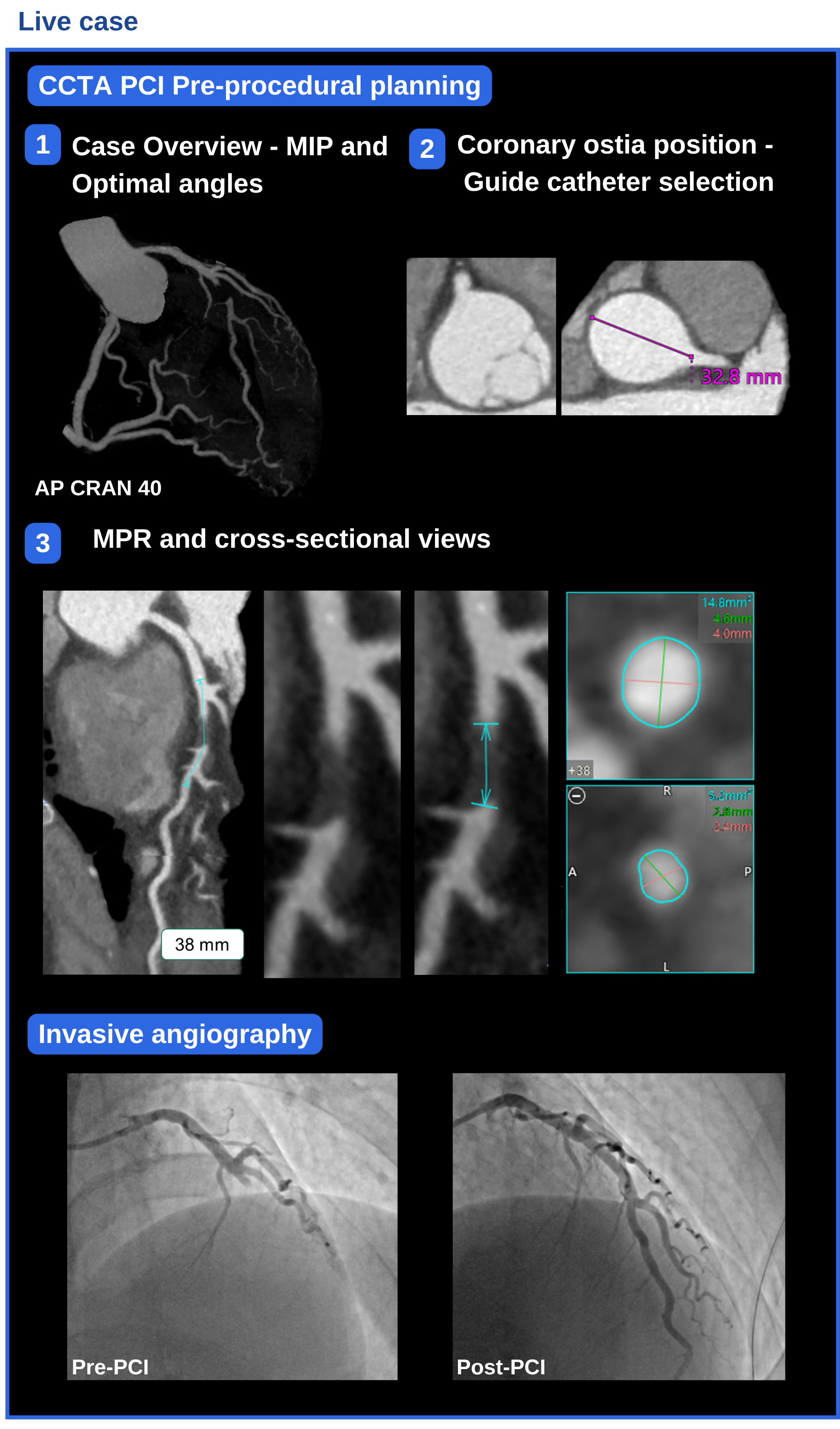 Coronary Computed Tomography Angiography to Guide Percutaneous Coronary ...