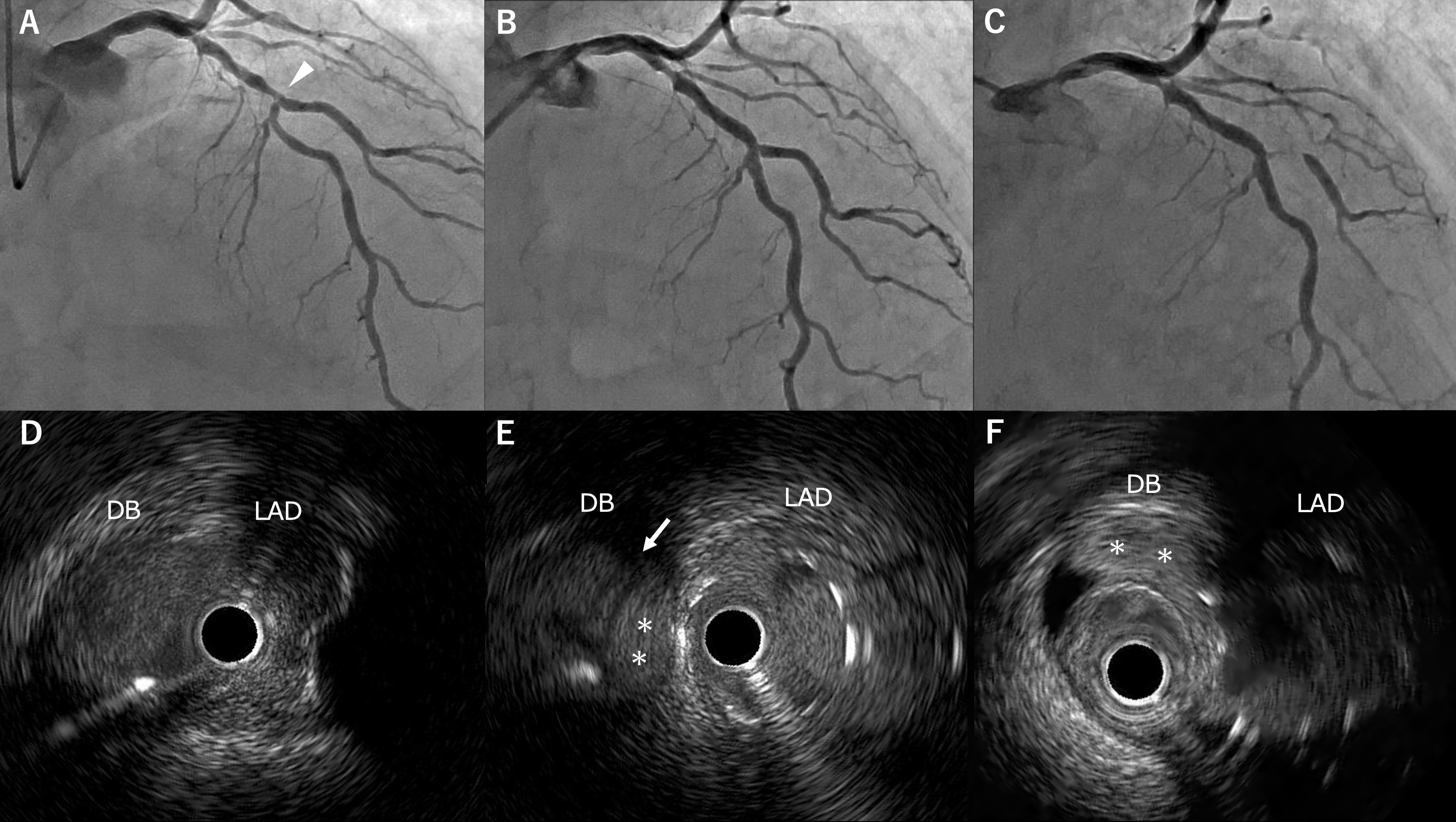 Intravascular Ultrasound-Detected Intimal Flap Predicts Acute Diagonal ...