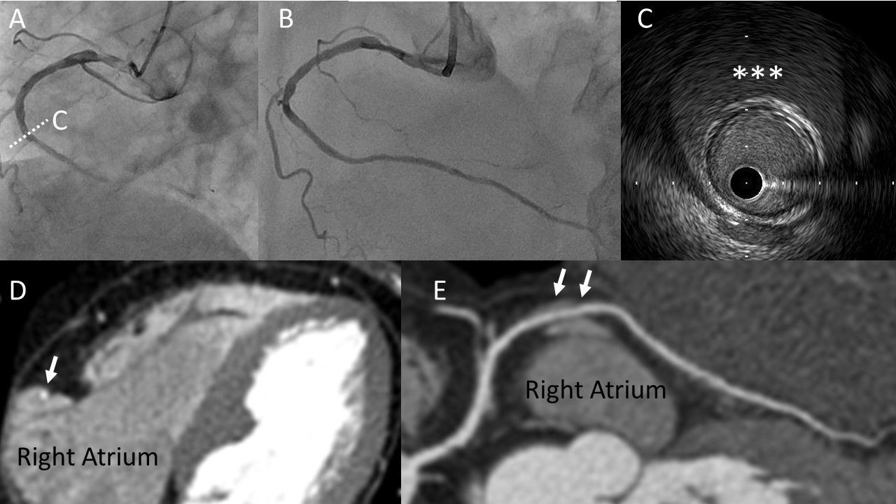 Right Atrial Appendage Detected by Intravascular Ultrasound
