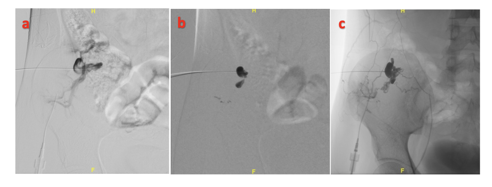 Percutaneous Glue Embolization of Ectopic Varices | VDM