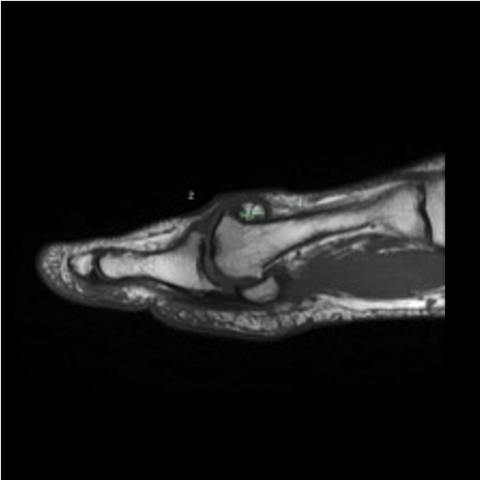 Addressing the Subchondral Bone Complex and First Ray Alignment in End ...