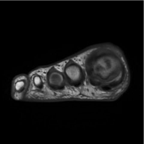 Addressing the Subchondral Bone Complex and First Ray Alignment in End ...