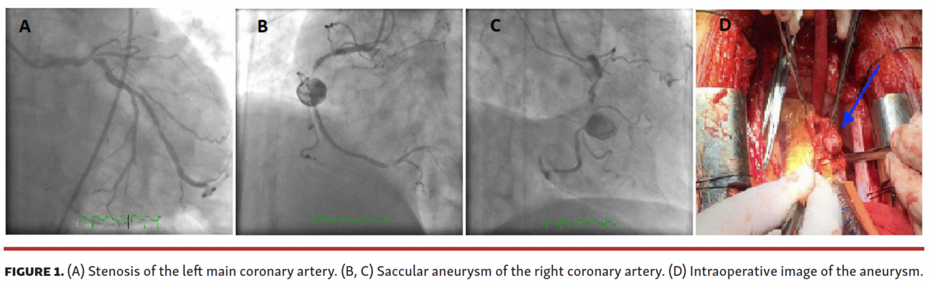 saccular aneurysm cause