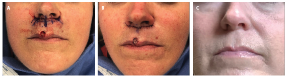 Upper Lip Lift Excision Used as Full-Thickness Skin Graft for Mohs ...